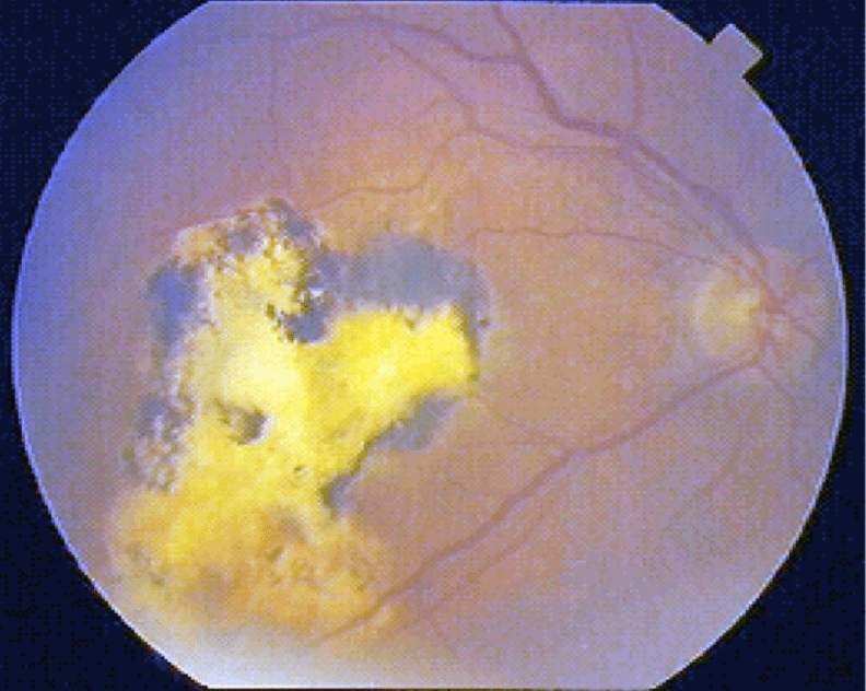 Learning to Live with Low Vision: One Man's Journey Through ...